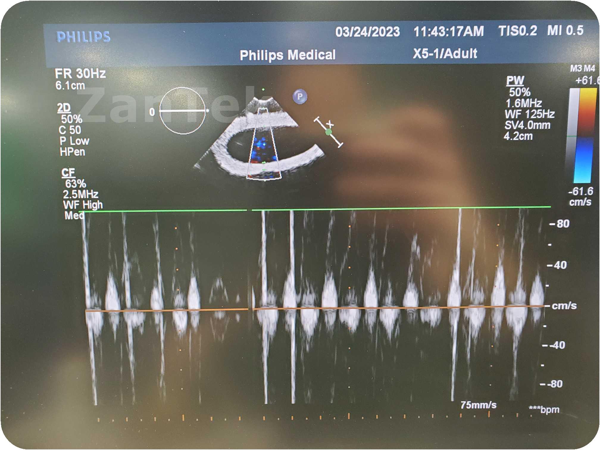 Zantek Medical - 320072-Philips X5-1 Ultrasound Transducer Probe