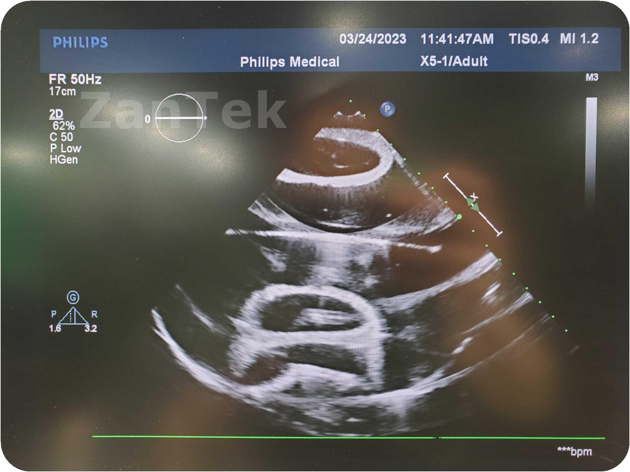 Zantek Medical - 320072-Philips X5-1 Ultrasound Transducer Probe
