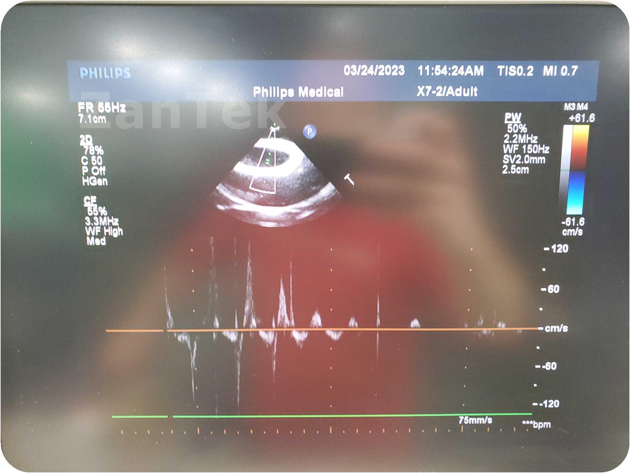 Zantek Medical - 320074-Philips X7-2 Ultrasound Transducer Probe