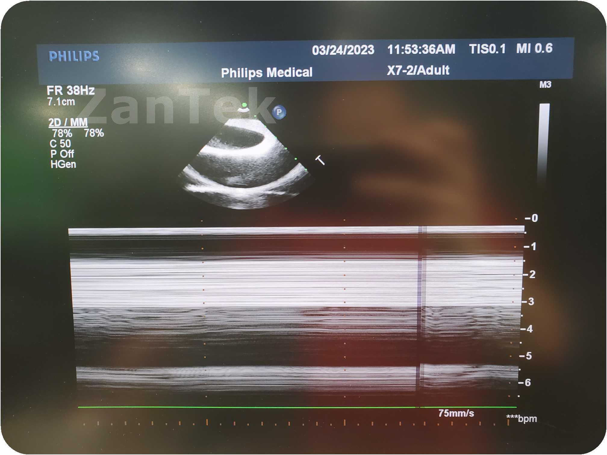 Zantek Medical - 320074-Philips X7-2 Ultrasound Transducer Probe