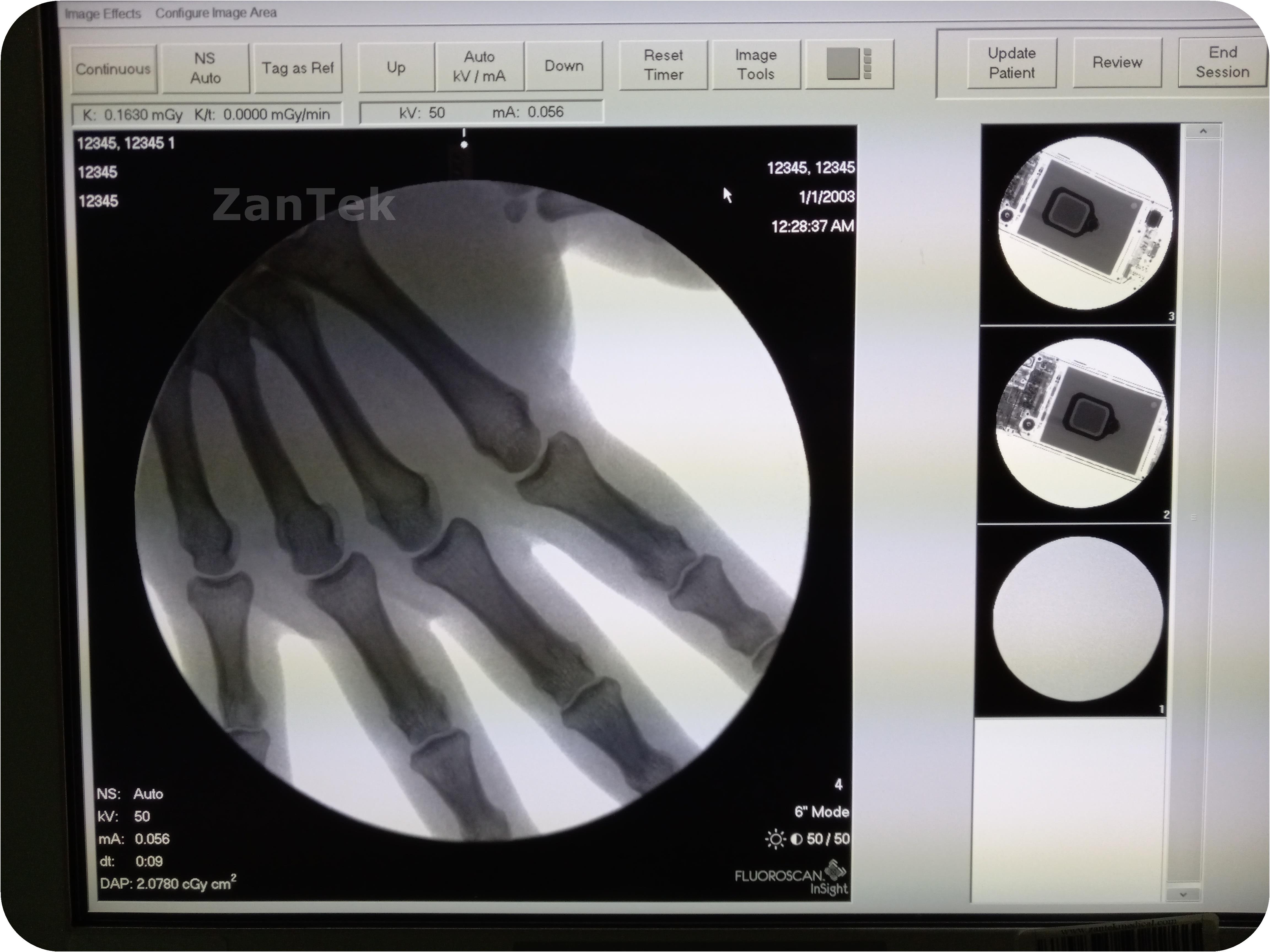 Zantek Medical - 321227-Fluoroscan InSight 2 Mini C-arm X-Ray Imaging ...